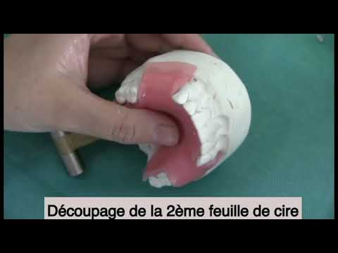 Montage des dents prothétiques postérieures en PAPR partie 1 réalisation de la maquette en cire