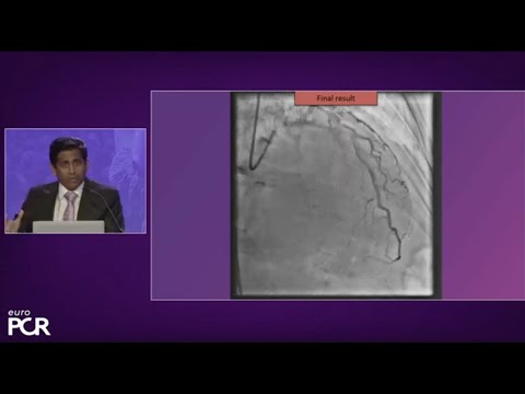 CAD treatment: sirolimus coated balloon and DES + DCB stent platform - EuroPCR 2023