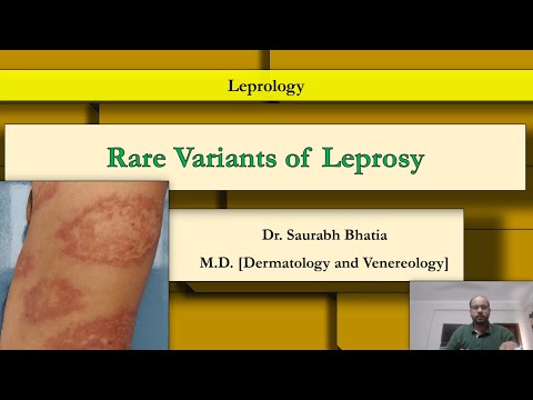 Rare Variants of Leprosy: Lucio, Lazarine, Histoid, Pure Neuritic, and other variants