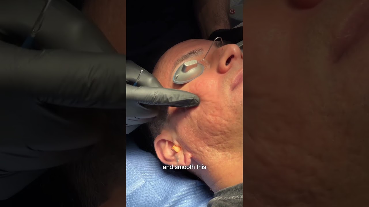 How Does Subcision Work For Stuck Acne Scars?