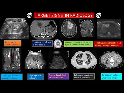 TARGET SIGNS IN RADIOLOGY