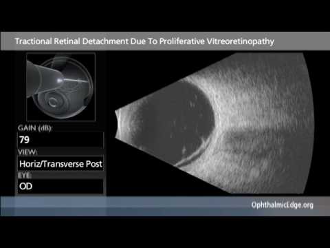 Tractional Retinal Detachment Due To Proliferative Vitreoret