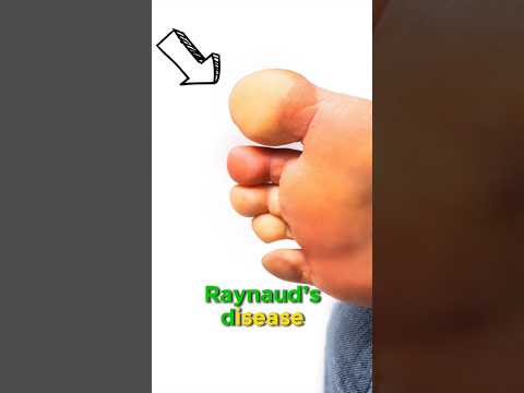 Do you have Raynaud's? The Do's and Don'ts!