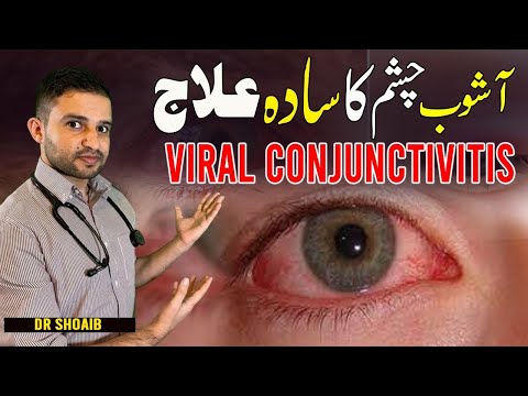 Viral Conjunctivitis Explained By Dr Shoaib In Urdu/Hindi