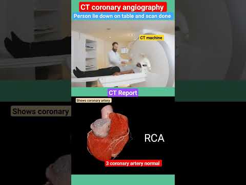 CT coronary angiography l #heart #coronaryartery #shorts