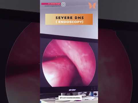 Severe DNS (#Endoscopy) or Deviated Nasal #Septum in crooked nose comes with a lot of challenges