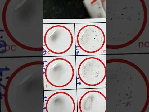 RPR test Reactive(1:64) | Serology || @labmedicine9265