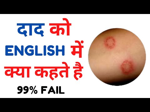 दाद को अंग्रेजी में क्या कहते है ? What is Daad meaning in english | Daad meaning in english