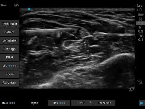 Median Nerve Block | Searcy EM