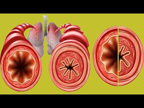 COPD Is The Same As Asthma: Is It True?