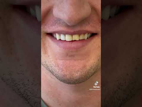 Smile Transformation by Dr. Tejas Patel #dentist #cosmeticdentist #veneers