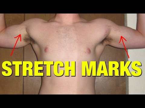 How to Remove Stretch Marks?