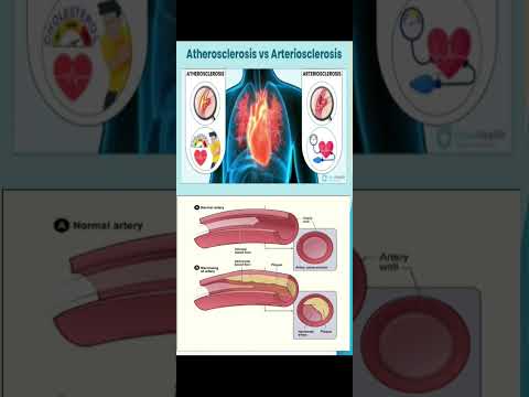 Atherosclerosis & Arteriosclerosis