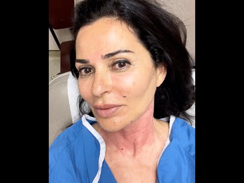 Jaw line tightening with morphues8 -Randall Feingold, MD, FACS