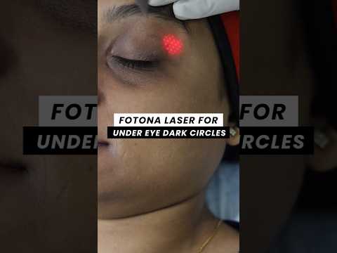 Fotona Laser for Under eye Dark Circles | ClearSkin Pune