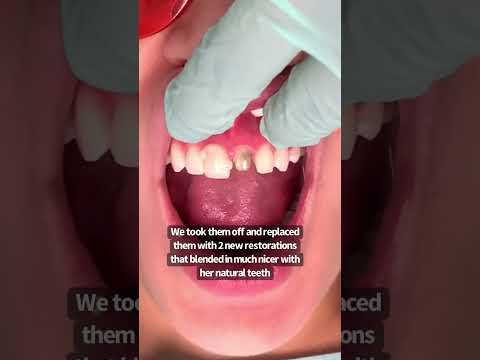 2 front teeth | porcelain crowns | dental crowns before and after | Dr. Yazdan | smile makeover