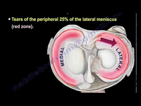 meniscus tear , knee injury ,lateral meniscus - Everything You Need To Know - Dr. Nabil Ebraheim