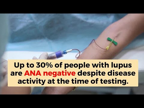 Time to rethink ANA as a lupus biomarker?