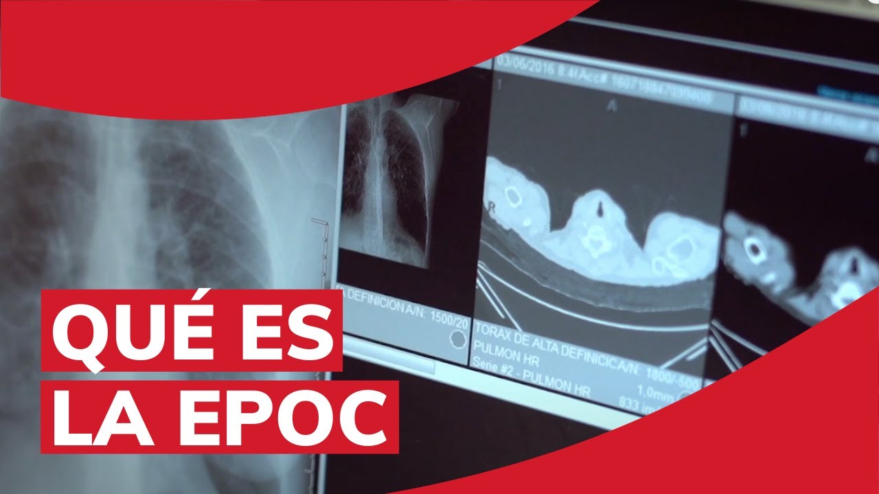 Qué es la EPOC, causas y síntomas