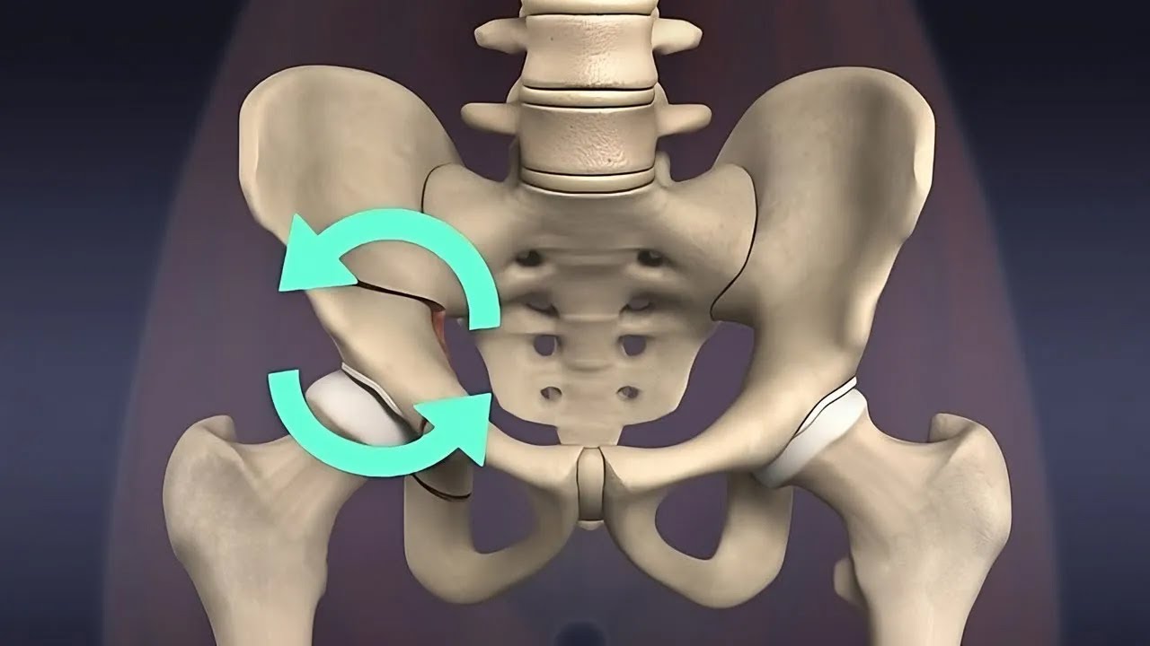 The Hip Dysplasia Solution: Periacetabular Osteotomy (PAO) Surgery (Medical Animation)