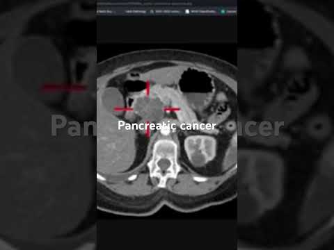 Image of pancreatic cancer #pancreaticcancer #pathagonia #gipath #cancer