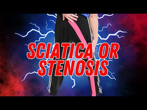 Is your Leg Pain Sciatica or Stenosis? How to Tell & How to Treat