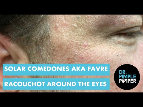 Dr. Pimple Popper Pops Blackheads Clustered Around Man's Eyes On Youtube