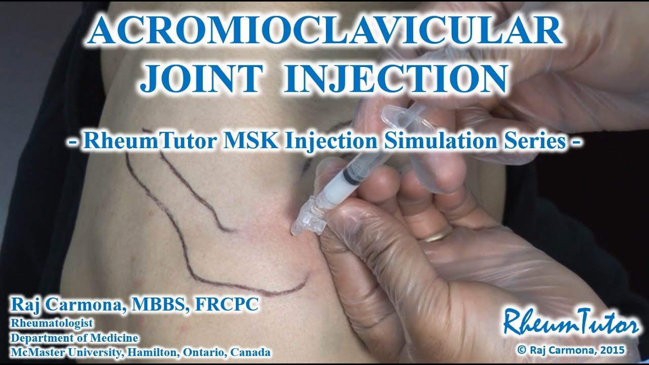 ACROMIOCLAVICULAR JOINT INJECTION: Step-By-Step Instructions