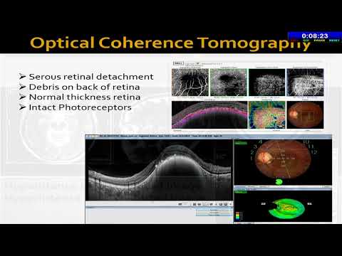 AIOC2020 IC387 T7 Dr Neiwete lomi Choroidal Melanoma what all you can do?