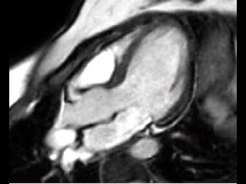 Cardiac MRI 2