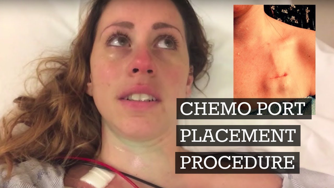 CHEMO PORT PLACEMENT PROCEDURE {VLOG}