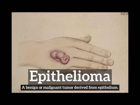How to Say Epithelioma in English? | How Does Epithelioma Look? | What is Epithelioma?
