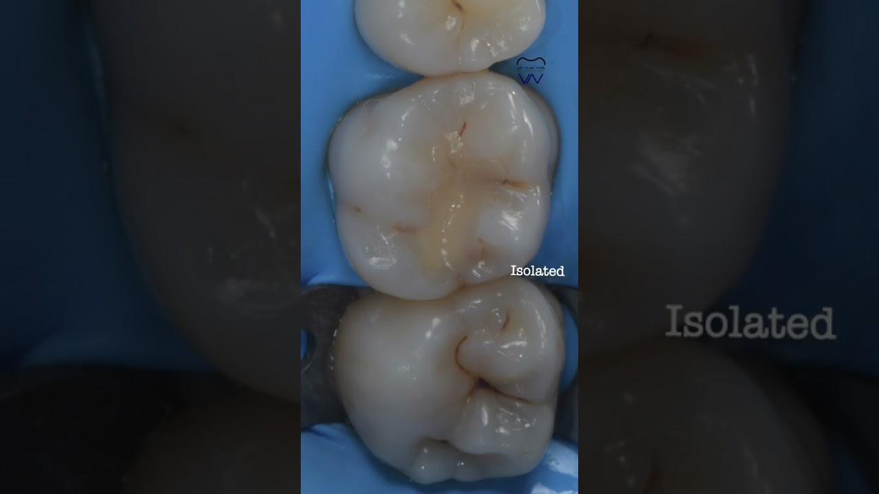 Cusp-by-cusp Direct Composite Loving #dentist