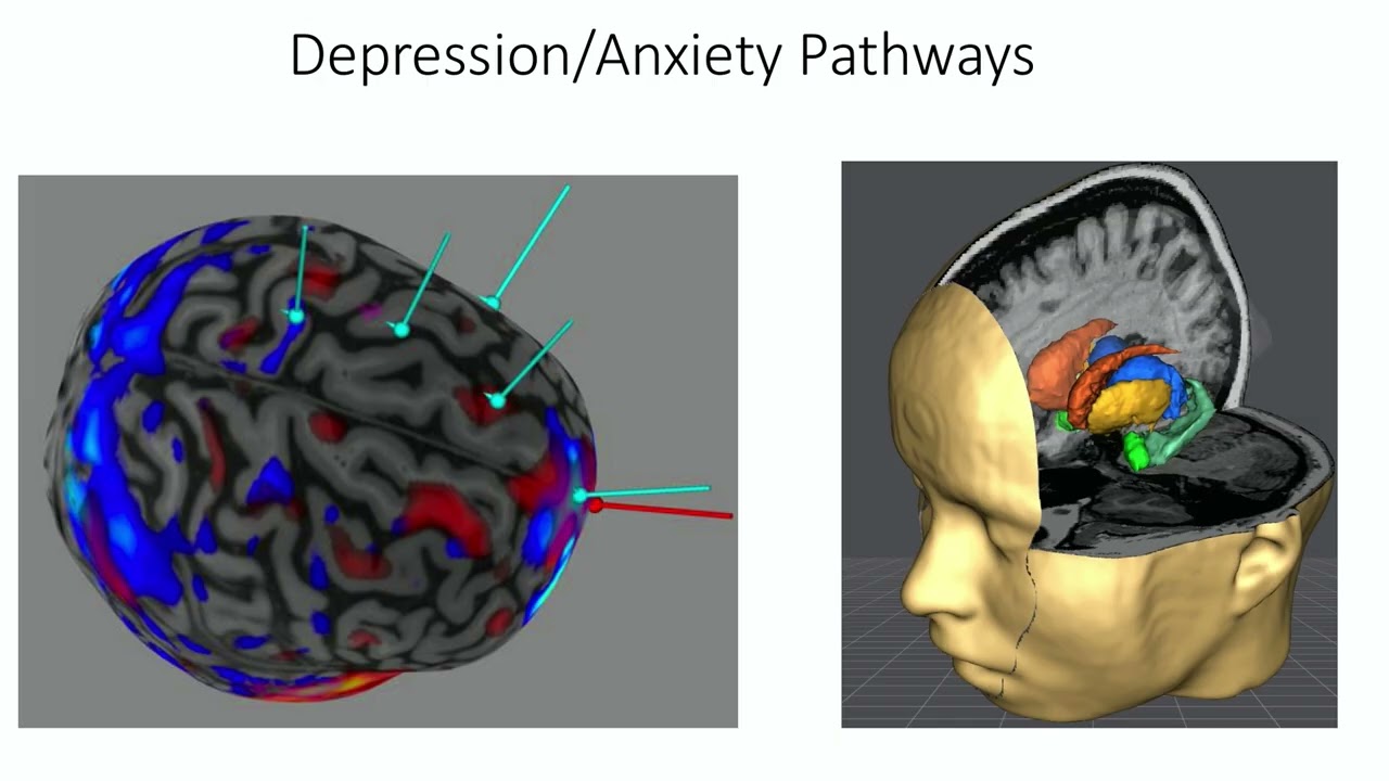 OHBM 2025 | Educational Course | How to Use MRI to Optimize Brain Stimulation | Part 8