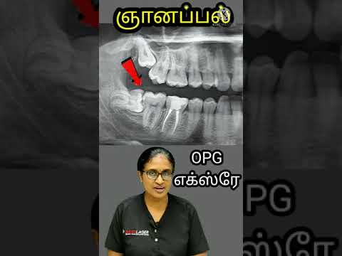 ஞானப்பல்லினால் ஏற்படும் பிரச்சனைகள்/ causes of wisdom teeth pain # shorts # wisdom teeth