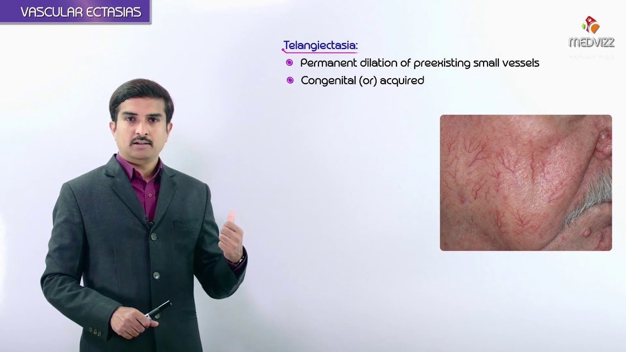 Vascular ectasias - Nevus flammeus (port-wine stain) , Salmon Patch , Telangiectasias