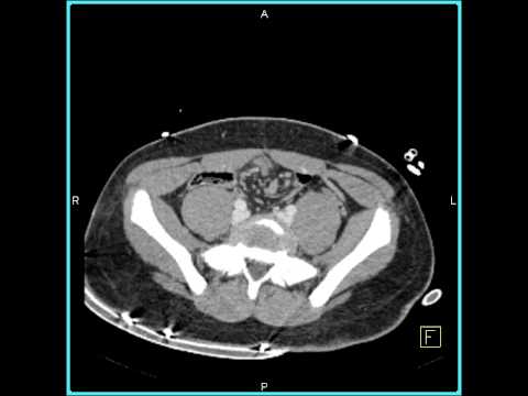 Abdomen: Small Bowel:Sworl:Series of axial images is a swirl of the mesentery consistent
