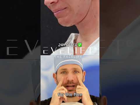 EVE Lift™ Patient Before And 24 Hours After With Dr. Ali Charafeddine | Eden Plastic Surgery | Miami