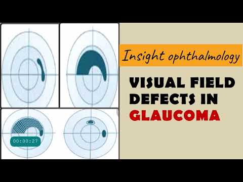 FIELD DEFECTS IN GLAUCOMA | arcuate, paracentral, nasal step, temporal wedge, baring of blindspot...