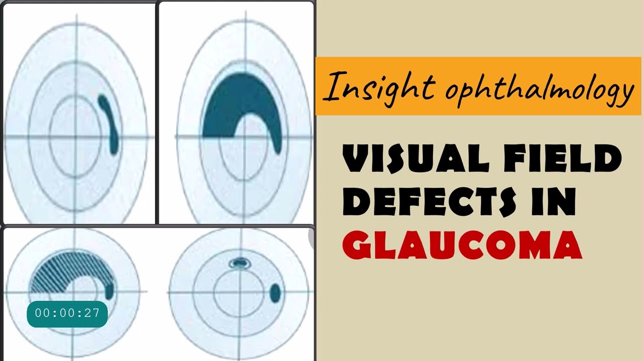 Understanding Visual Field Defects In Glaucoma Galaxy Ai