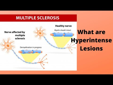 What are Hyperintense Lesions