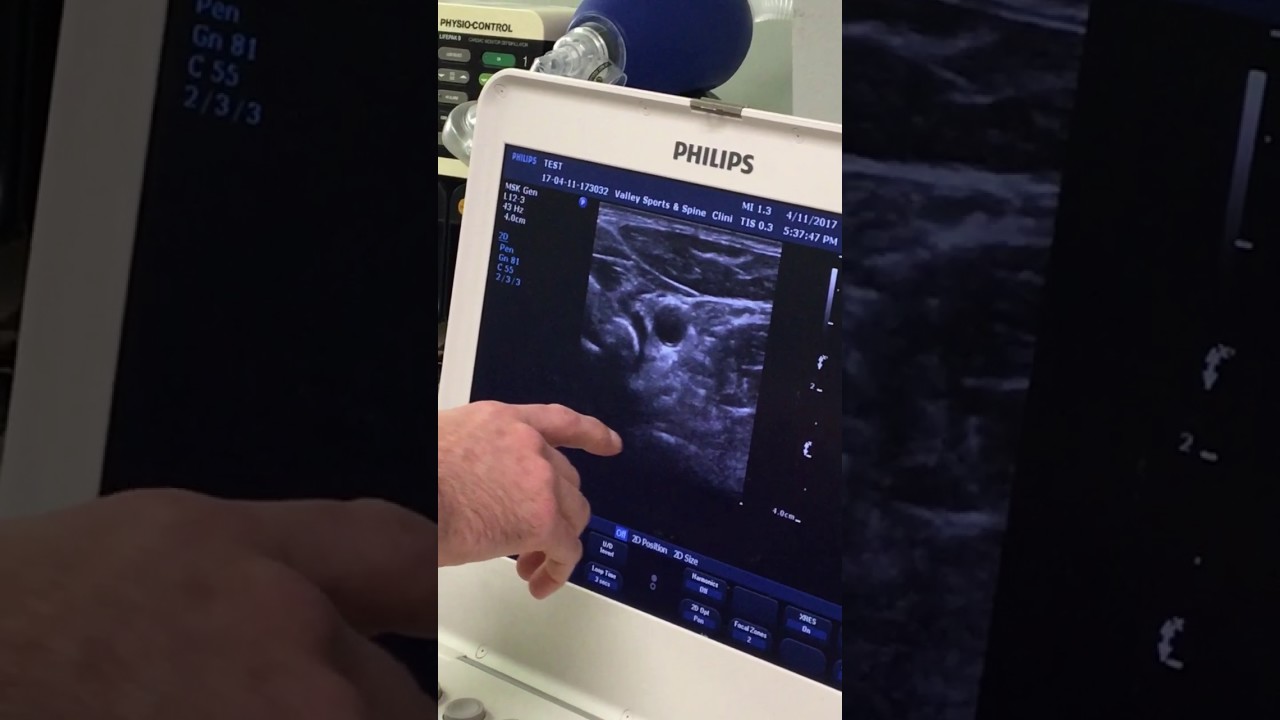 Longus colli function and chin tucks