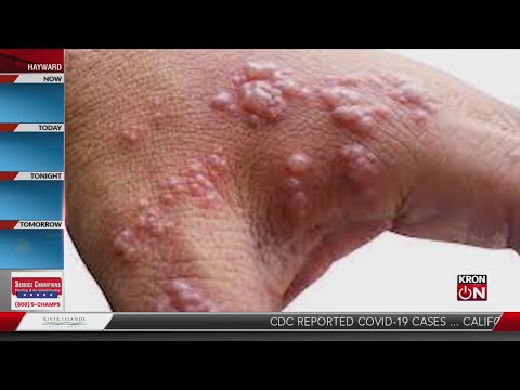 How easy is it to catch monkeypox?