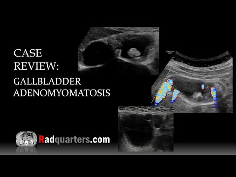 Ultrasound of Gallbladder Adenomyomatosis