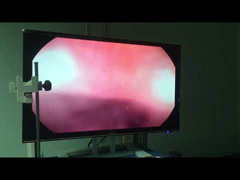 Colonoscope showing Juvenile polyp in a young child with bleeding per rectum