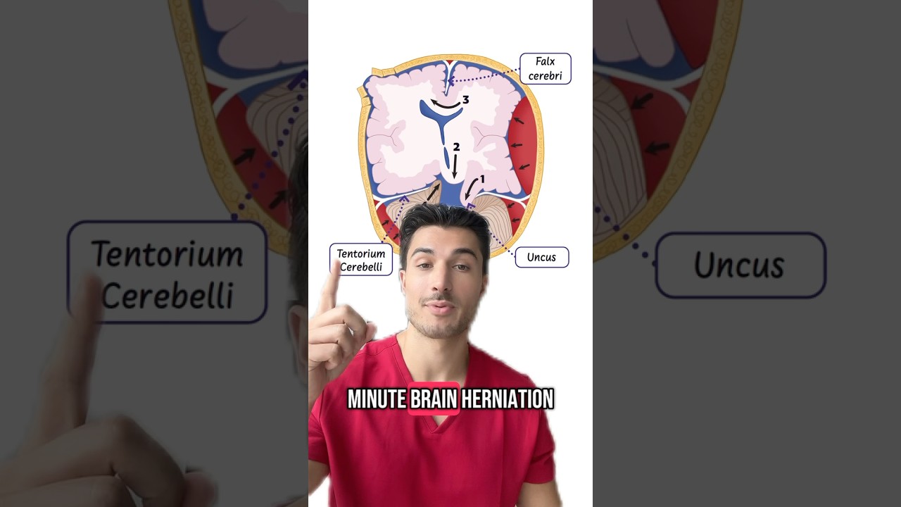 Let’s breakdown Brain Herniations 🧠🩸#medstudent #medschool #usmle #usmlestep1 #neurology