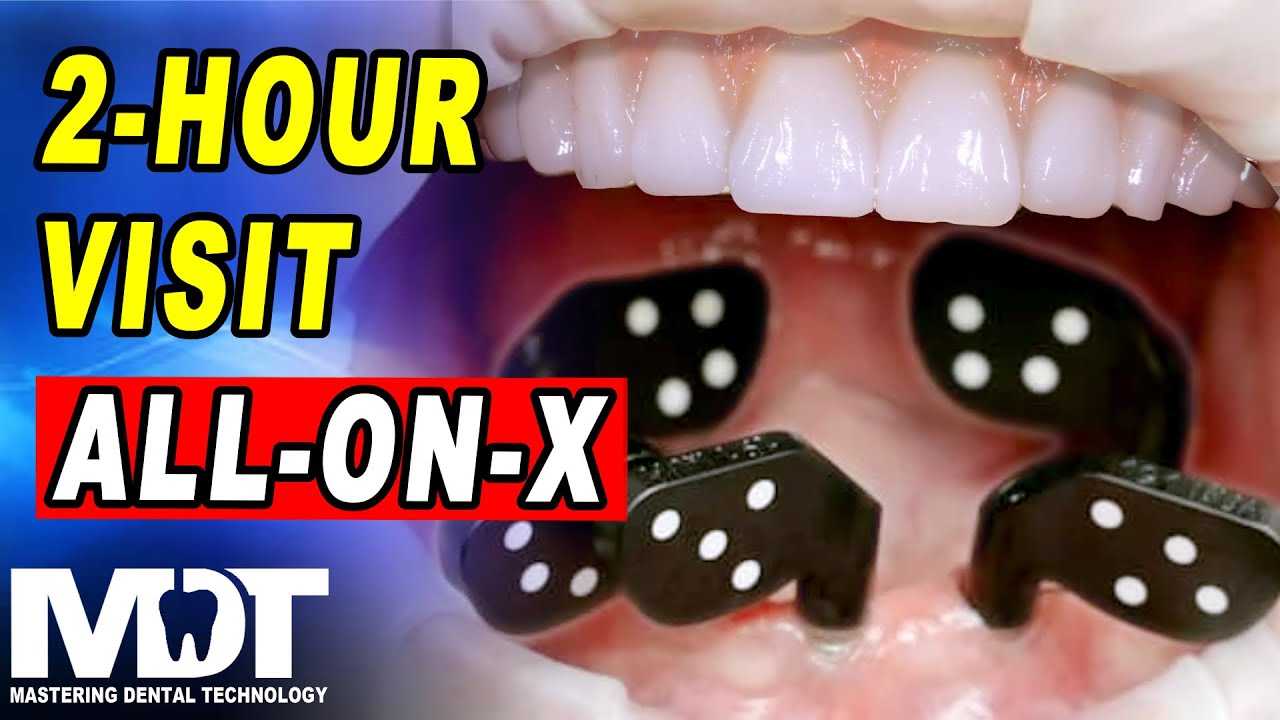 All On 4 in 2 hours [ Full Clinical and Lab Workflow ]