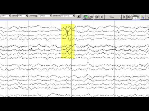 Small Sharp Spikes (Mini Lesson #1 - Updated)