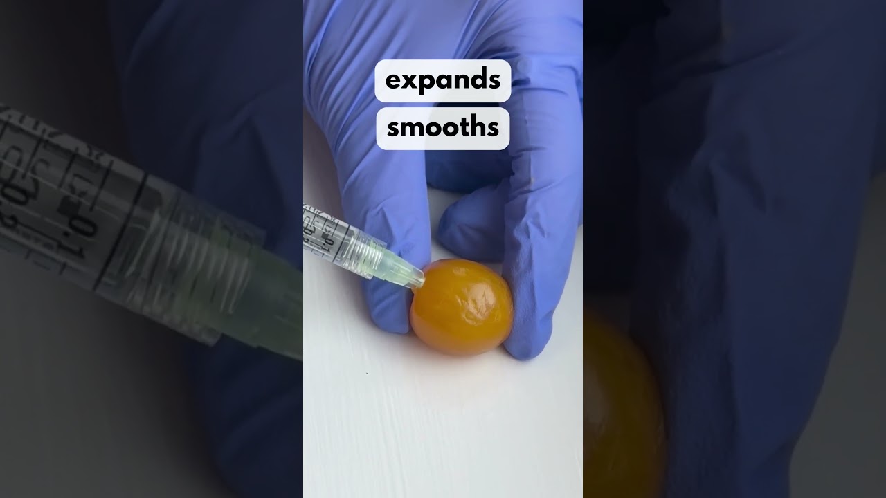 How Dermal Fillers Work