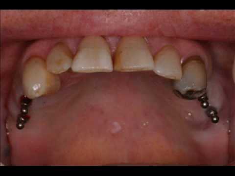 IMTEC Mini Dental Implants and Full Bridges